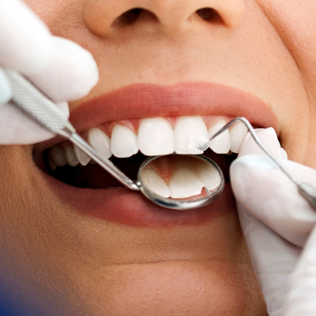 Composite Bonding for your Perfect Smile — service image
